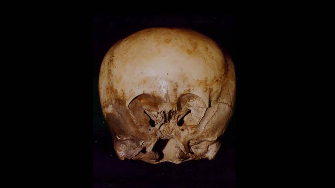 The Mysterious Starchild Skull: A Fascinating Enigma That Continues to ...